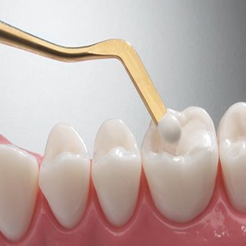 The Benefits of Composite Fillings – Willoughby Dental