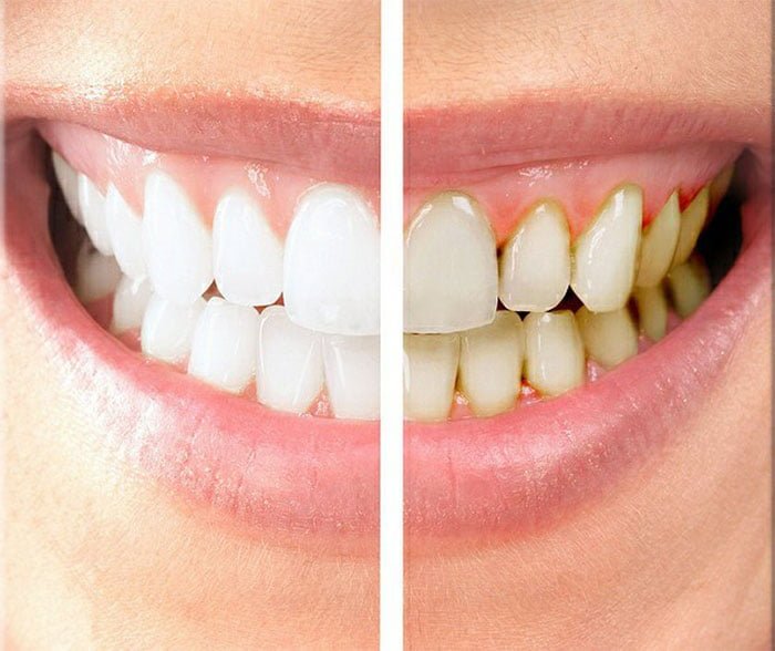 Turn That Old Smile New with Porcelain Veneers | Dr. Matthew Warner