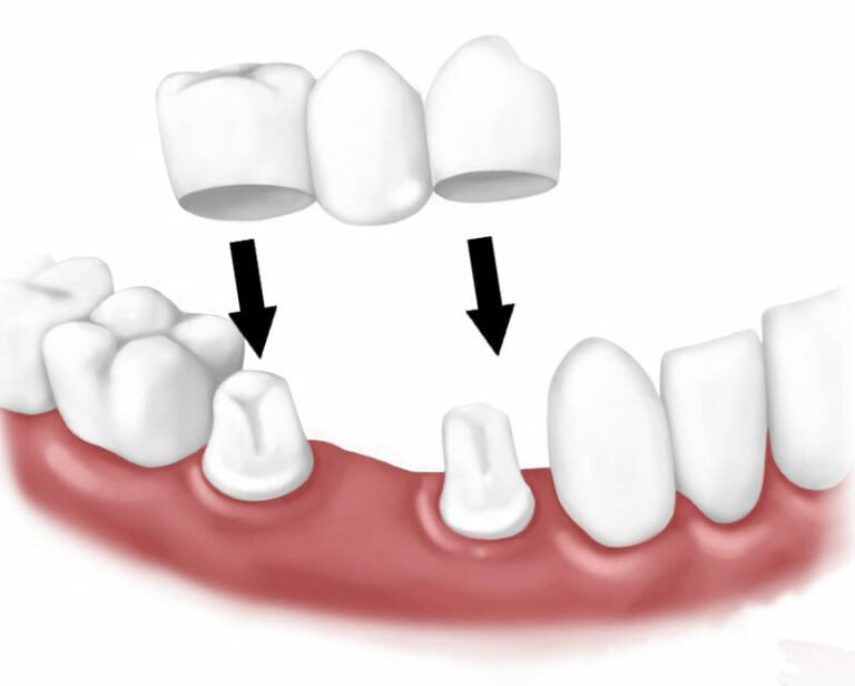 Understanding Your Dental Bridge Options | Dr. Matthew Warner