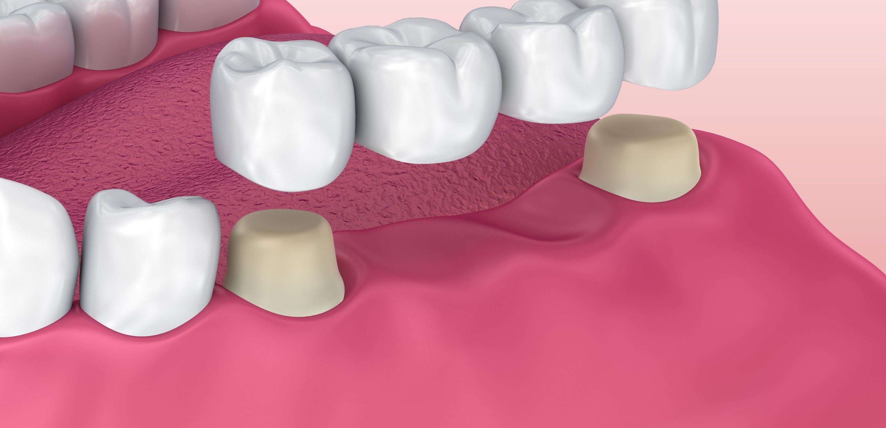 Dental Bridges in Greenville, SC | Willoughby Dental